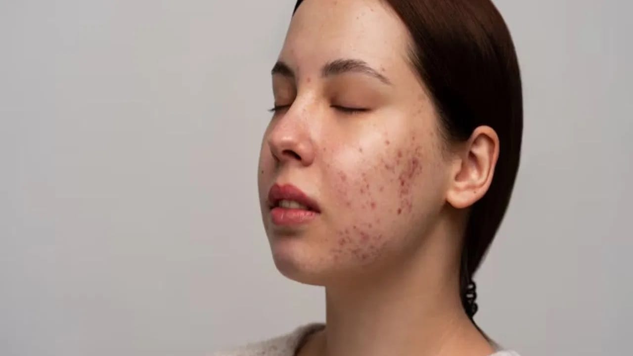 ਮੁਹਾਸੇ ਬਰਸਾਤ ਦੇ ਮੌਸਮ ਵਿੱਚ ਨਹੀਂ ਹੋਣਗੇ ਪਿੰਪਲਸ, ਇਹ ਗਲਤੀਆਂ ਕਰਨ ਤੋਂ ਬਚੋ ...