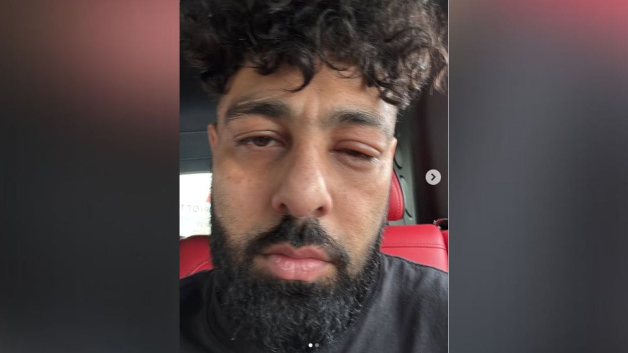 ਜਖ਼ਮੀ ਹੋਇਆ ਰੈਪਰ ਬਾਦਸ਼ਾਹ, ਅੱਖ ਤੇ ਲੱਗੀ ਸੱਟ, ਖੁਦ ਫੋਟੋਆਂ ਕੀਤੀਆਂ ਸਾਂਝੀਆਂ ...